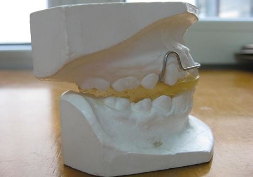 Functional Appliance Orthodontics For Upper And Down Connection Good Retention