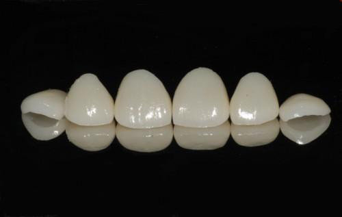 Comfort Durable Porcelain Dental Veneers with thickness 0.5MM No Side Effect