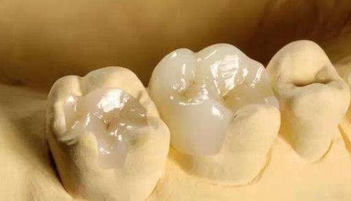 Large Cavities Porcelain Inlays And Onlays For Tooth Surface Small Defect