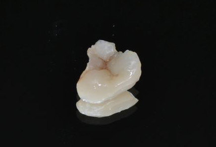 FDA Zirconia Dental Inlay for Salvage Small Surface Defect of Nature Tooth