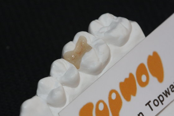 Durable Zirconia Dental Inlays And Onlays Similar Natural Teeth Wear Resistance