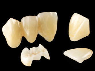 Full Casting Ceramic Dental Inlays / Onlays Durable No Any Allergy Stain Resistant