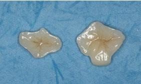 Strong Dental Inlays Restorate For Tooth Small Damage In Dental Lab ISO9001/2000