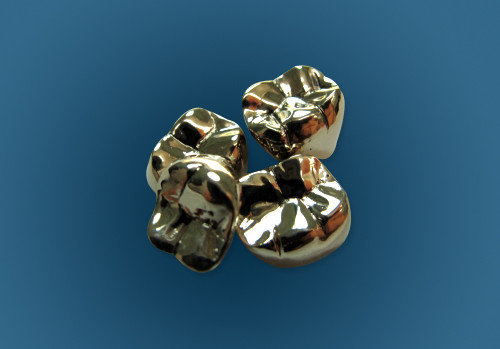 Metal Alloy Full Cast Of The Bridge Platinum And Palladium With Restorations