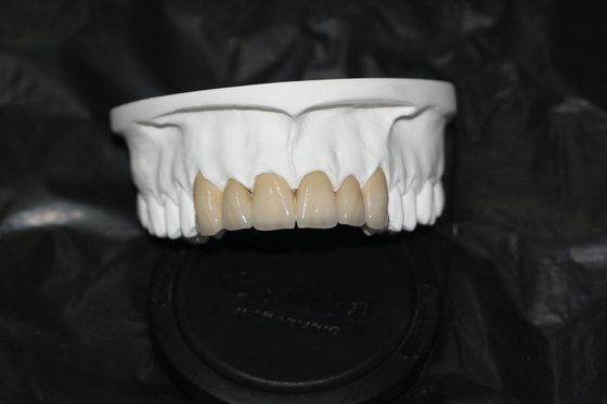 All Ceramic Zirconia Dental Crown High Intensity , Implant Supported Bridge