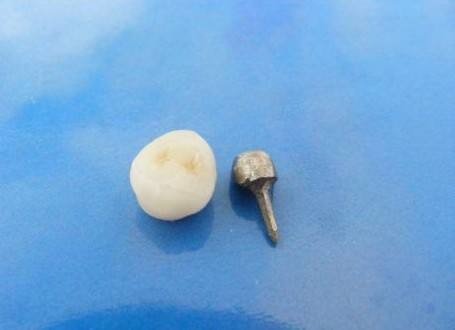 Common and Economic PFM Dental Crown Metal Dental Post and Core