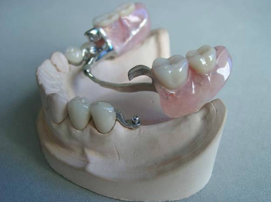 Dental Precision Attachments with Cobalt Chromium Material Reducing Stress