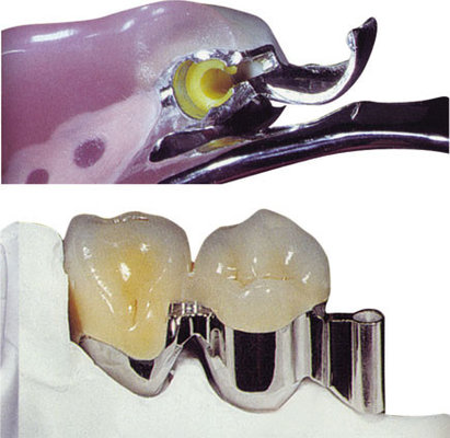 Easy Clean Precision Attachment Partial Denture For Restore Missing Teeth