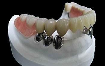 Co-Cr Material Dental Precision Attachments Tooth Telescope Crowns Removable