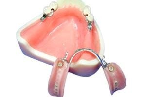 Dental Ball And Socket Attachment , Precision Attachment Removable Partial Denture