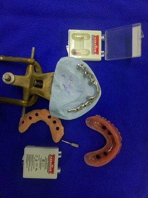 Improve Bitting Force Implant O Ring Attachment For Tooth Supported Mandibular Overdenture