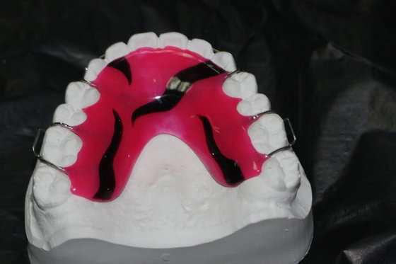 Traditional Lingual Arch Orthodontic Dental Retainer Removable To Straighten Teeth