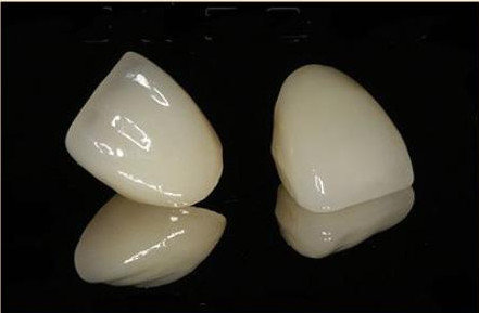 Porcelain Dental Veneers 0.6MM For Tetracycline Teeth With Colour Stability