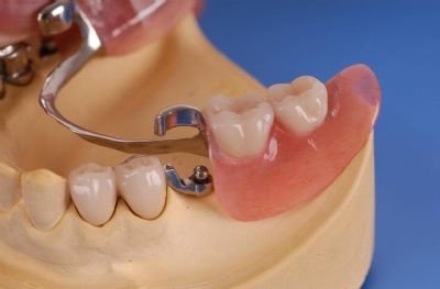 No Allergy Teeth Dental Precision Attachments High Retention FDA ISO9001 Certification