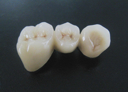 Pure Titanium PFM In Dentistry Metal and Safe No Any Poisonous Side Effect