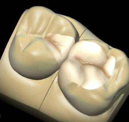 Composite Dental Veneers good to restore small damage of tooth surface