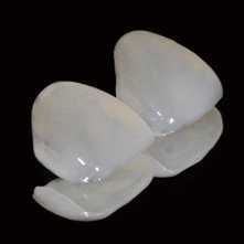 0.2MM Thickness Composite Dental Veneers Supperthin and Valued