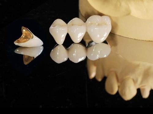 New technology Captek Nanogold crowns to restore your tooth better