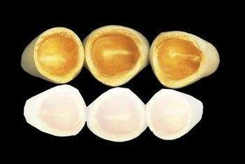 Gold composite Captek Nanogold Crowns Restoration Porcelain bonder