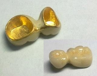 Unique and Luxury Gold composite Captek Naogold crowns restoration
