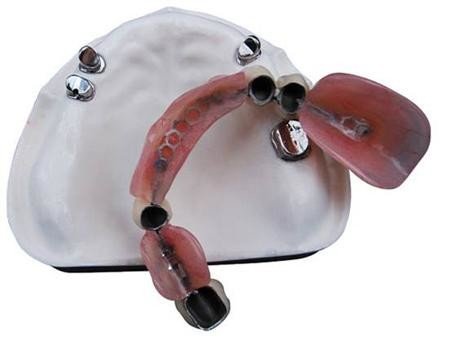Telescopic Crowns Dental Precision Attachments For Implant Supported Restorations
