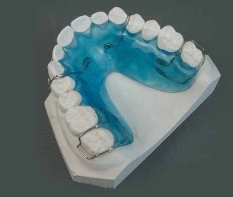 Traditional Orthodontic Appliances For Tongue Thrust , Modification Metal Retainer