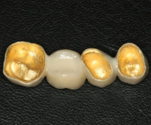 Highly Accurate Tooth Bridge Dental Crown Lab，Gold Dental Caps And Crowns