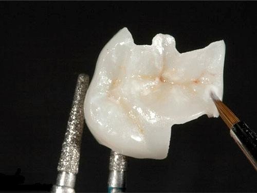 Titallium Alloy Ceramic Inlays And Onlays Distinguished Biocompatible For Dental Clinic