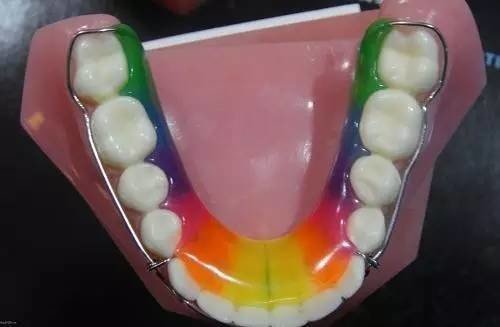Stainless Steel Dental Fixed Orthodontic Appliances with Three Direction Arch Expansion