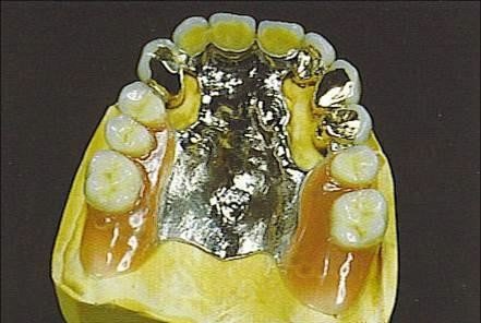Durable Dental Precision Attachments , Telescopic Crown And Bridges Good Retention