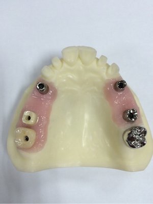 Denture Lab Advanced Implant Abutment And Crown Good Biocompatibility
