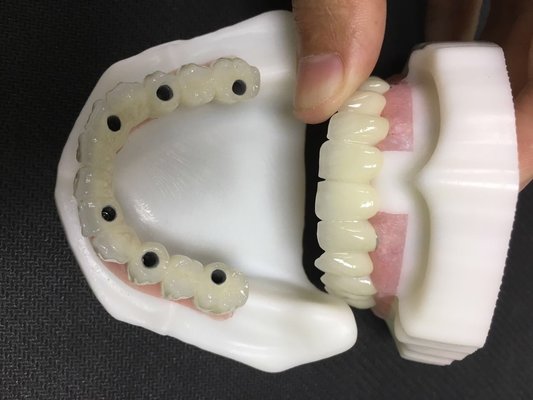 Lava Zirconia Dental Crown Dental Bridge Replacement Easy Clean Wear Resistance