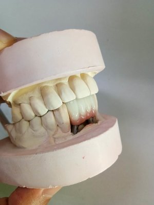 High Strong Zirconia Dental Implant Crown , Full Arch Implant Bridge For Missing Teeth