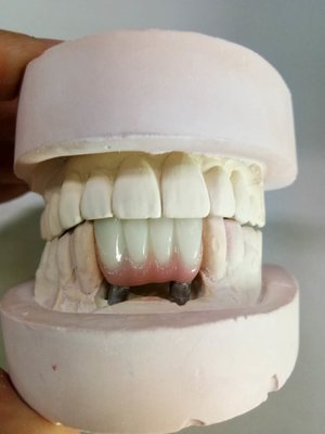 Zirconia Dental Implant Crown , Tooth Implant Crown High Corrosion Resistant