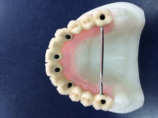 Palladium Silver Ceramic Implant Crown / Implant Bridge For Dental Laboratory ISO13485