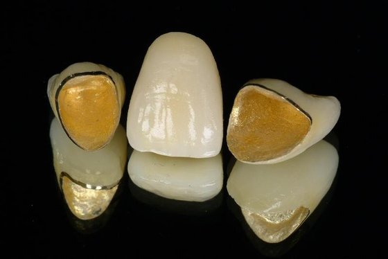 Dental Crown Lab Captek Caps And Bridge For Teeth , Strong Dental Implant Bridge
