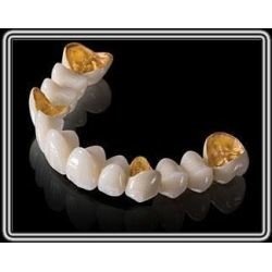 Captek Gold Dental Crown Lab On All Teeth Good Biologycial Strong Restoration