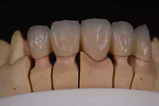 Palladium Silver Ceramic Front Teeth Veneers Corrosion Resistance Good Biocompatibility