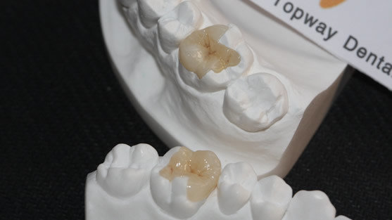 Porcelain Inlays And Onlays For Filling Tooth Defect Excellent Dental Aesthetics