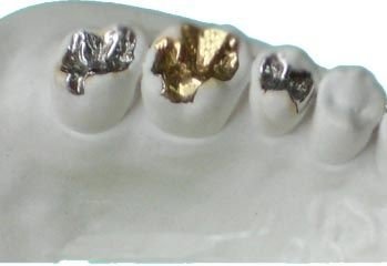 Noble Metal Alloy Dental Inlays And Onlays For Replacement Old Fillings