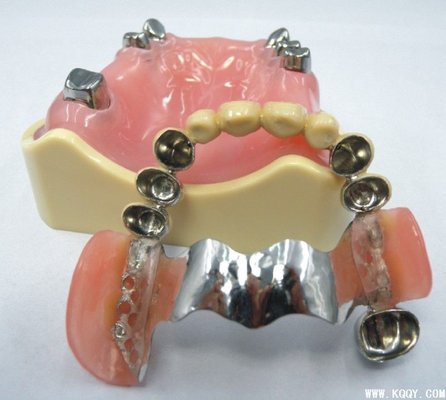Telescopic Overdenture Precision Attachments In Dentistry With Palladium Silver Material