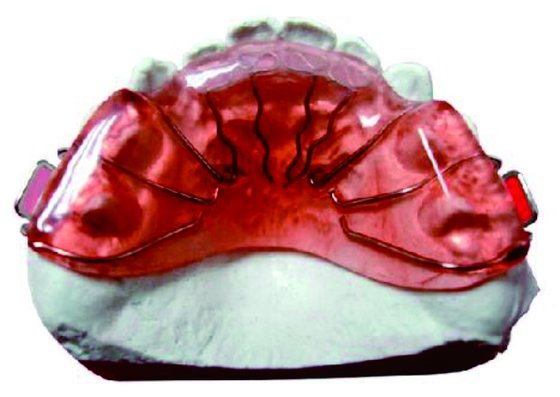 Removable Functional Appliances In Orthodontic Treatment For Dental Laboratory