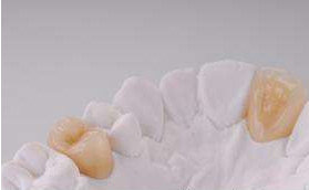 Dental Lab BIO HPP Teeth Crowns High Safety With Health Restoration Materiral