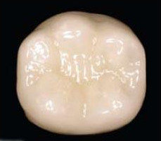 Peek Optima And BioHPP Material Crown No Any Allergy Permanent Dental Prosthesis