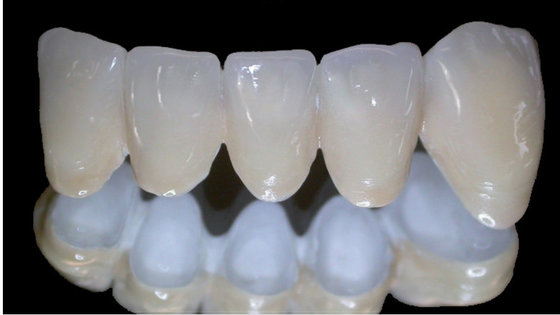 Popular Peek Optima BIO HPP Dental Crowns And Bridge High Stiffness