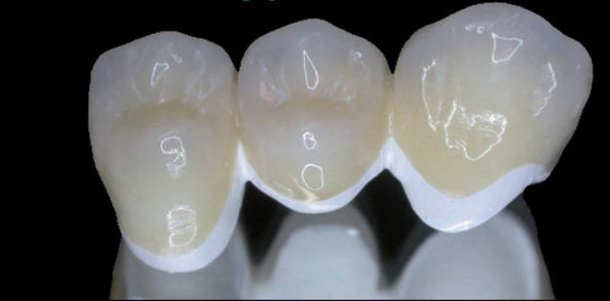 Good Biological Dental Lab BIO HPP Crowns For Clinical And Scientific Studies