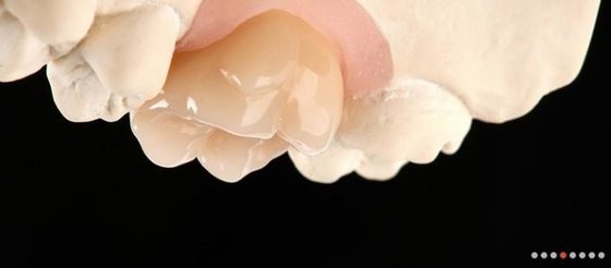 ISO13485 BioHpp Crown And Bridge Dental Lab Perfect Luxury Fixing Restorations