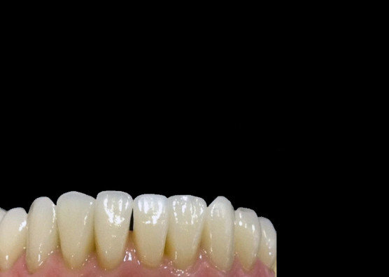 Beautifully Fine BIO HPP Crowns , Dental Bridge Crown Gracefully Delicate Currency