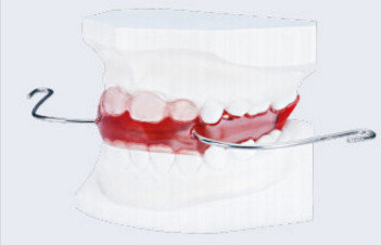 Extraoral Traction Functional Dental Appliance , Orthodontic Braces For Adults