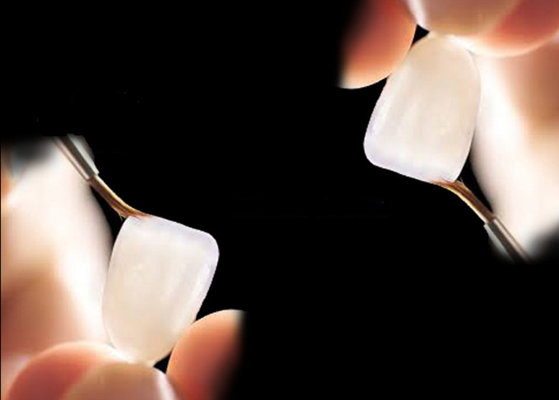 Cosmetic Dentistry Porcelain Dental Veneers With Treatments Crowns / Bridges